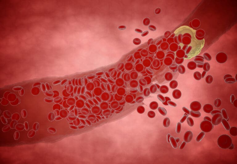 Alarming Symptoms Of Clogged Arteries You May Not Have Noticed